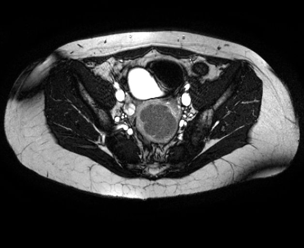 UKGM Gießen/Marburg - Myomembolisation